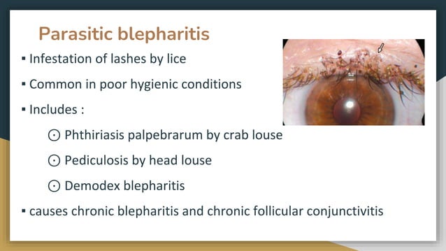 BLEPHARITIS - introduction, types, Etiology, pathogenesis, clinical ...