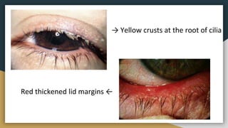 BLEPHARITIS - introduction, types, Etiology, pathogenesis, clinical ...