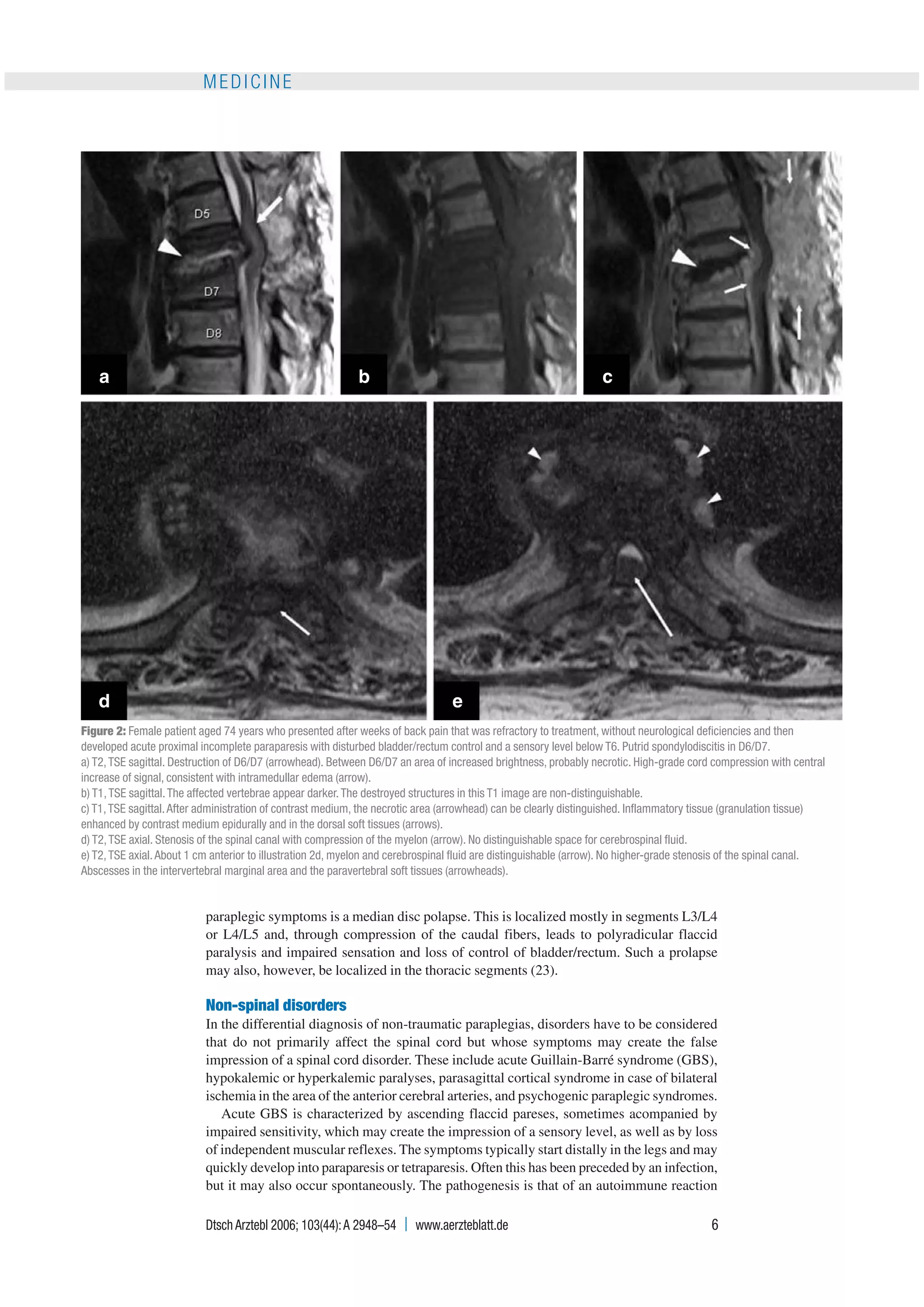 DDX Paraplegia | PDF