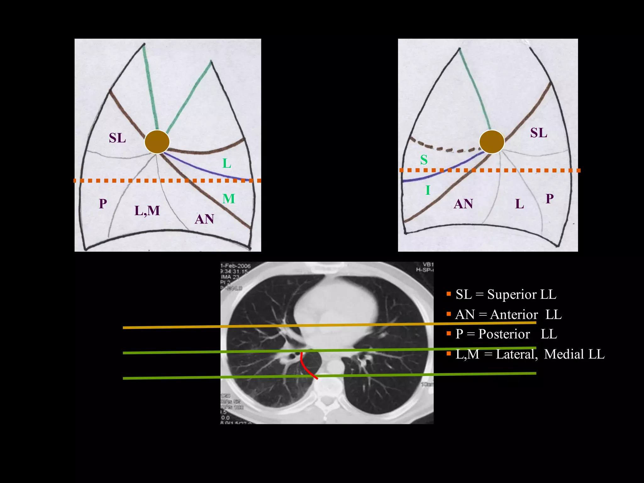 Segmental anatomy of lungs , anatomy of mediastinum and secondary ...