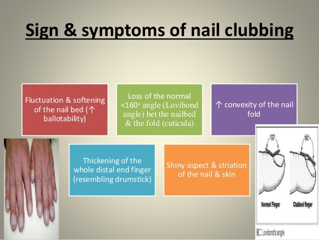 Fingernail Clubbing Lung Cancer