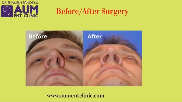 Nosies chirurgijos kaina – Nosies pertvaros operacija