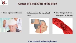 Blood Clot In Brain Treatment In Chennai | Neurologist In India | PDF ...