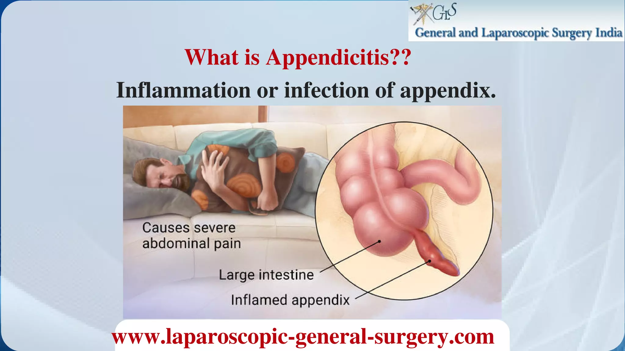 Appendix Removal Surgery In Bangalore | Laparoscopic Appendicitis Surgery In India | PDF