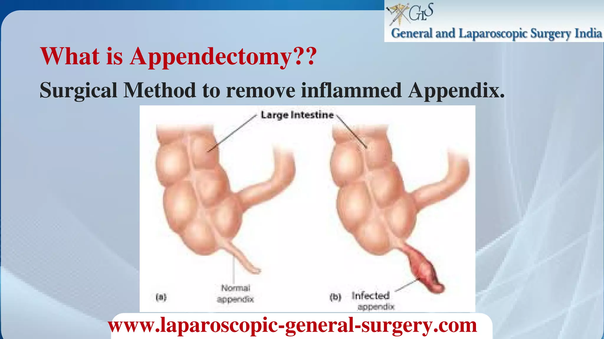Appendix Removal Surgery In Bangalore | Laparoscopic Appendicitis Surgery In India | PDF
