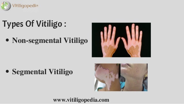 Vitiligo Treatment Centre In Bangalore | White Spot Removal In India