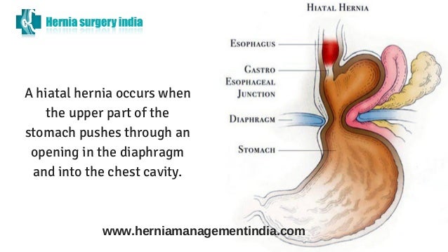 Laparoscopic Hiatal Hernia Repair in Chennai | Hernia Surgery in India