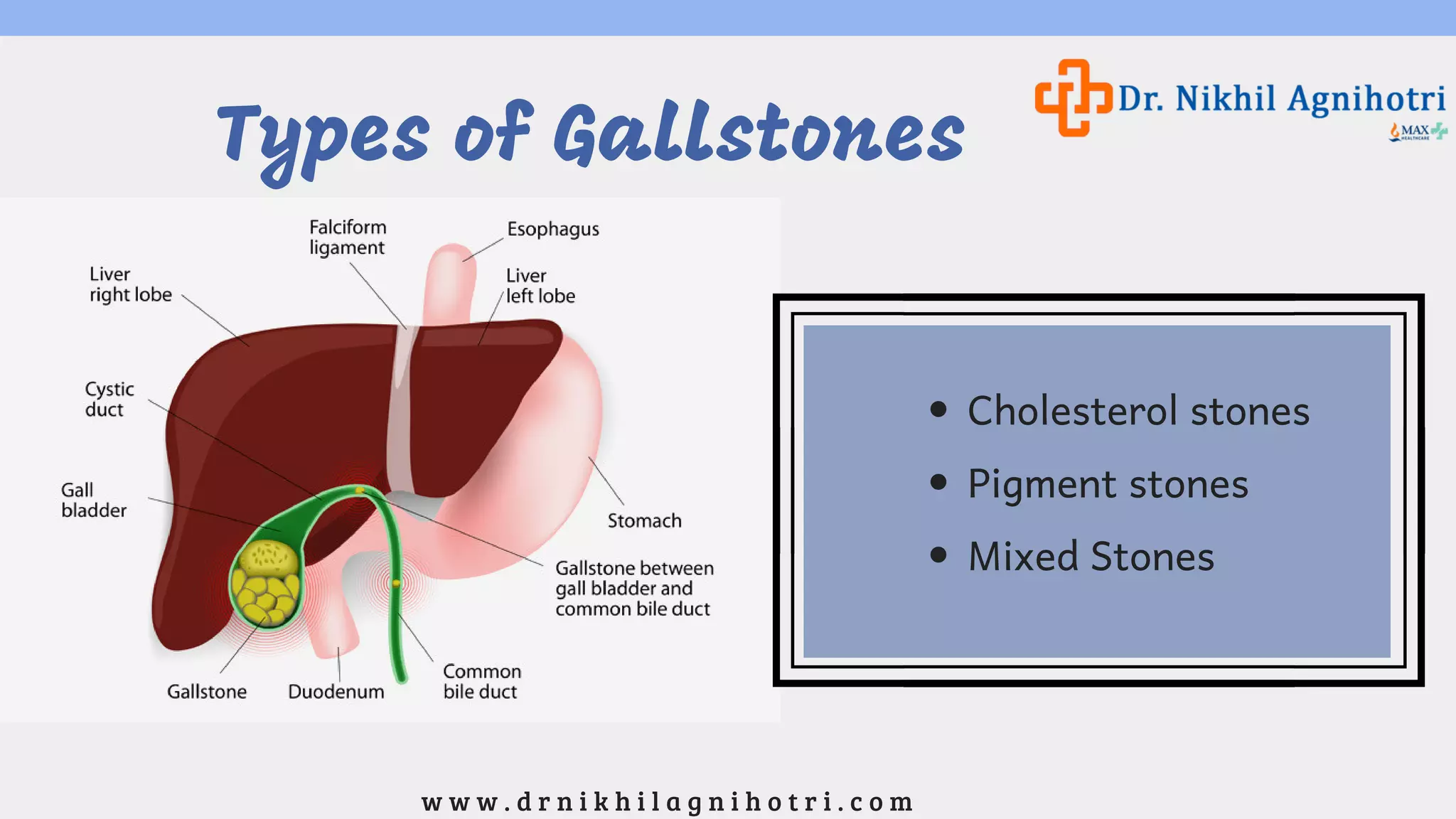 Gall Stone Treatment in Mumbai | Laparoscopic Cholecystectomy in India ...