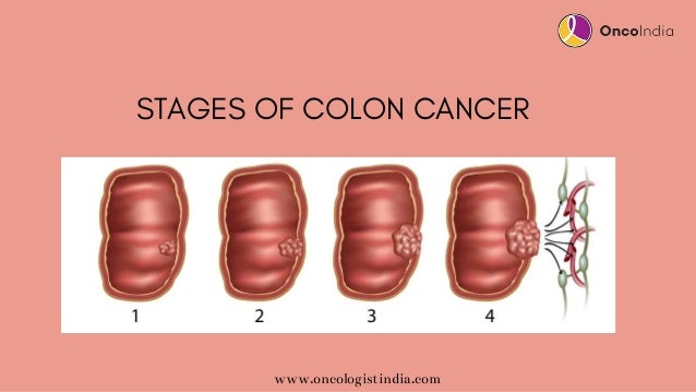 Colon Cancer Treatment in Bangalore | Colon Cancer Treatment Options ...