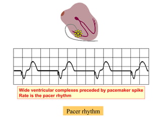 Rapid Review of basic ECG