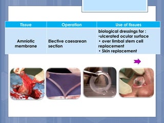 Tissue banking (2) | PDF