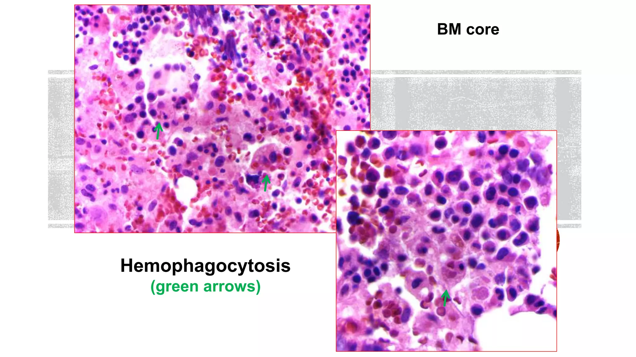 Hemophagocytic Lymphohistiocytosis - HLH | PPTX