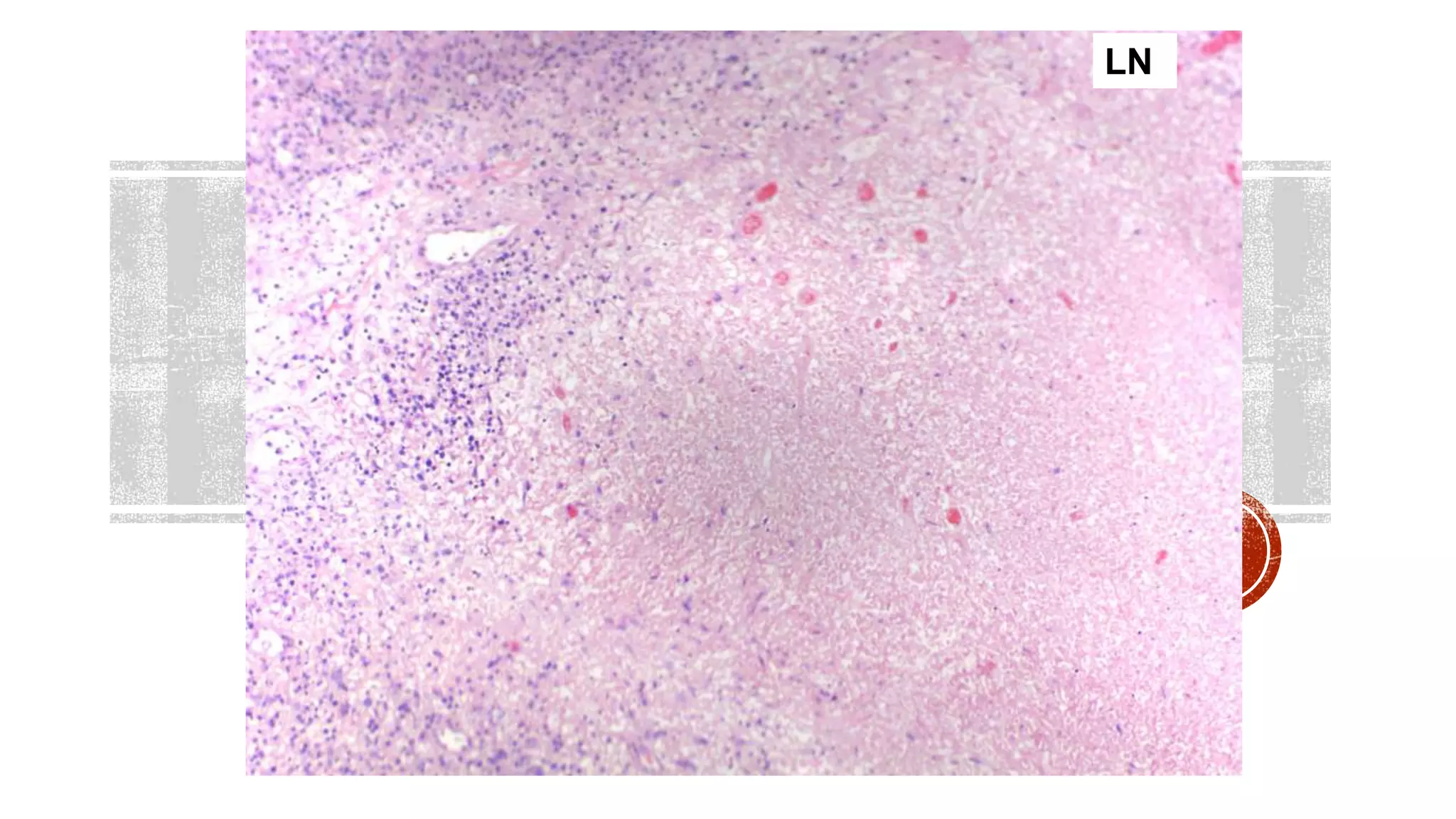 Hemophagocytic Lymphohistiocytosis - HLH | PPTX