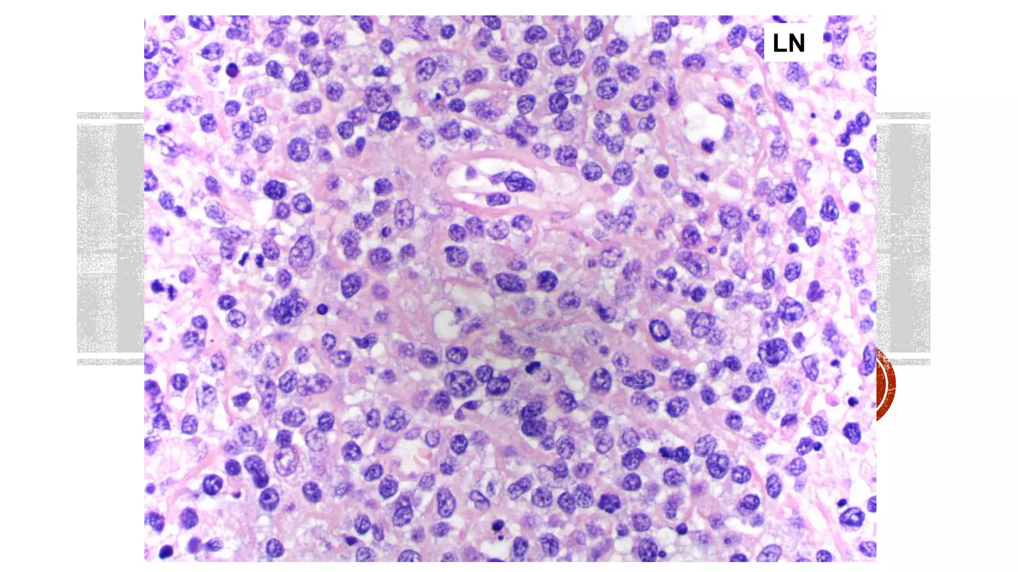 Hemophagocytic Lymphohistiocytosis - HLH | PPTX