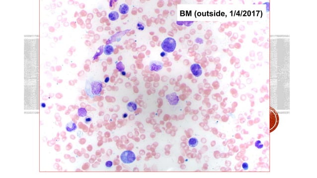 Hemophagocytic Lymphohistiocytosis - HLH | PPTX | Blood Disorders ...