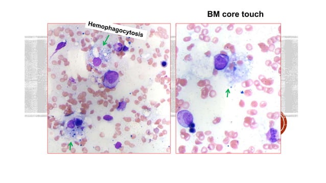 Hemophagocytic Lymphohistiocytosis - HLH | PPTX | Blood Disorders ...
