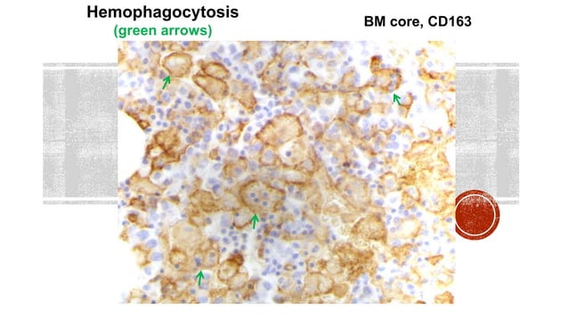 Hemophagocytic Lymphohistiocytosis - HLH | PPTX | Blood Disorders ...