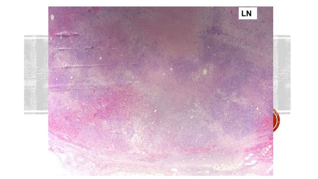 Hemophagocytic Lymphohistiocytosis - HLH | PPTX | Blood Disorders ...