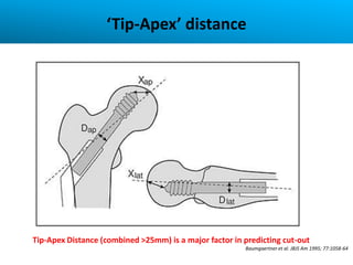 Hip Fracture Fixation with X-Bolt | PPTX | Bone and Joint Conditions ...