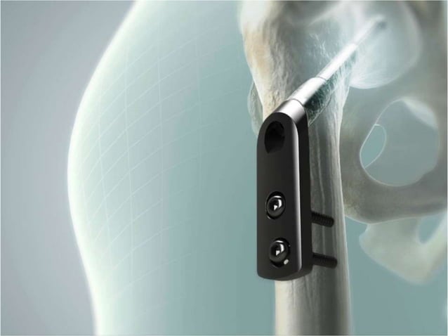 Hip Fracture Fixation with X-Bolt | PPT