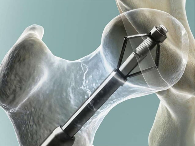 Hip Fracture Fixation with X-Bolt | PPT