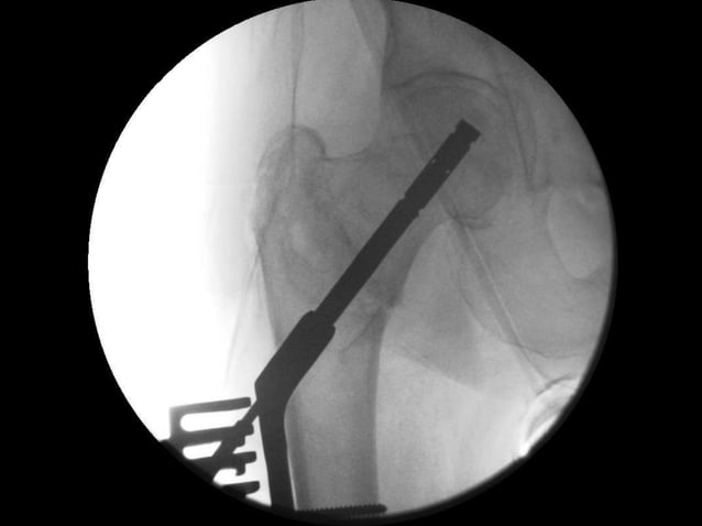 Hip Fracture Fixation with X-Bolt | PPT