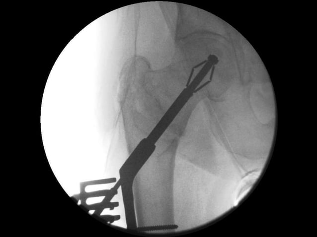Hip Fracture Fixation with X-Bolt | PPT