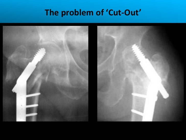 Hip Fracture Fixation with X-Bolt
