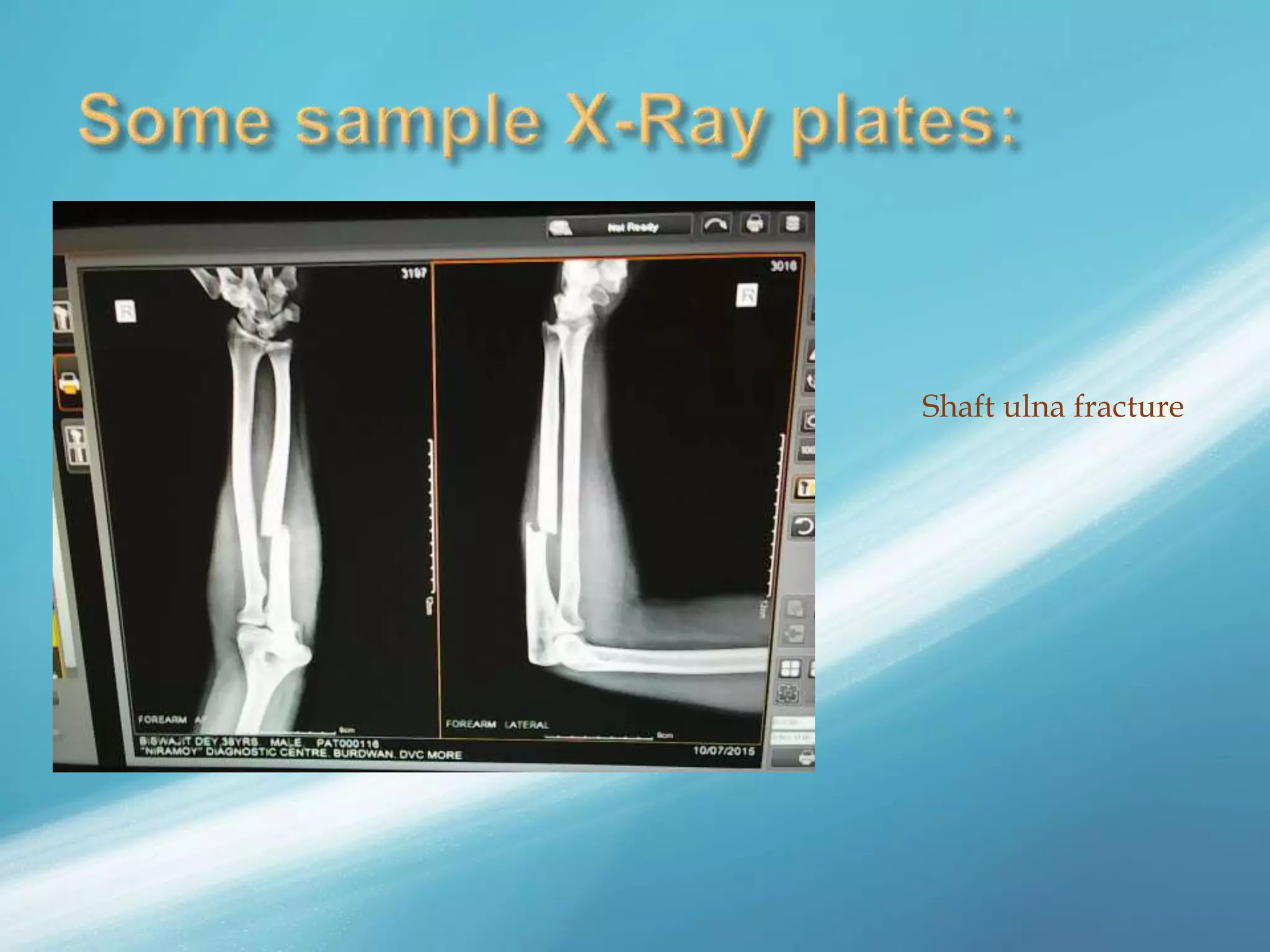 X-Ray | PPTX