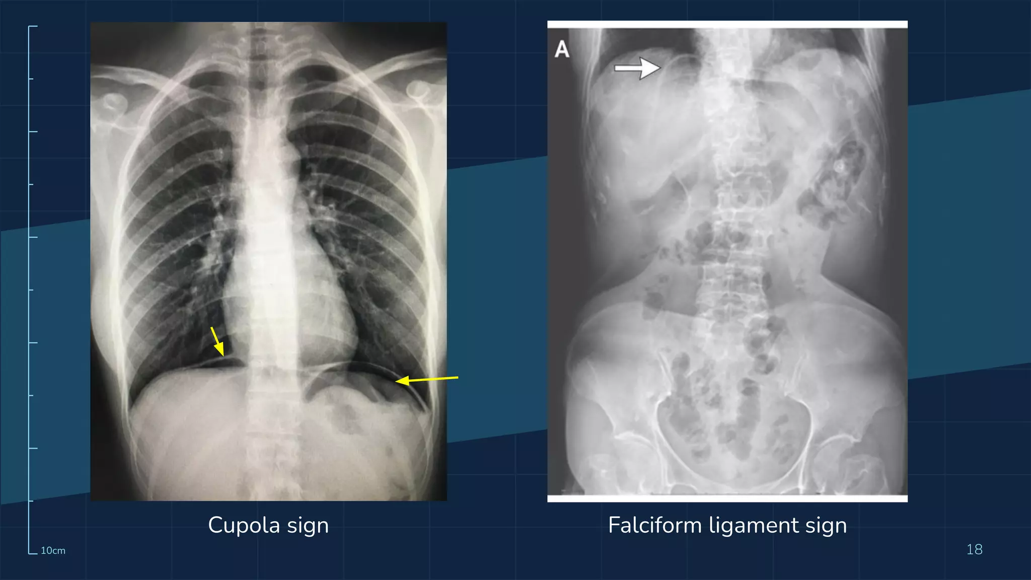 X-Ray Abdomen Lena.pdf