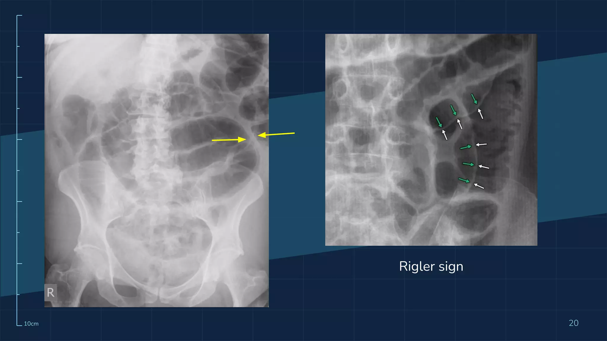 X-Ray Abdomen Lena.pdf