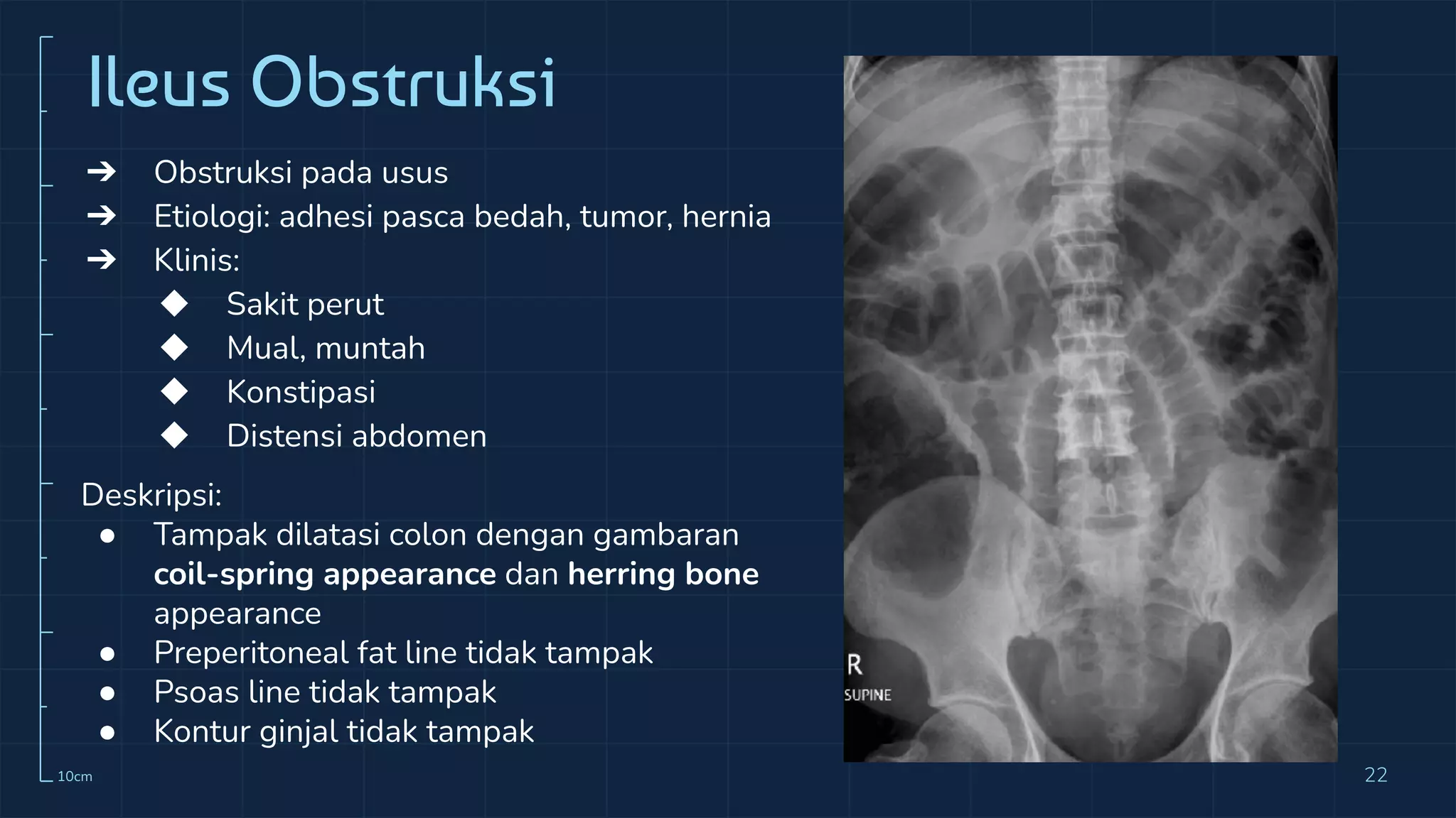 X-Ray Abdomen Lena.pdf