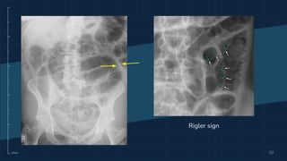 X-Ray Abdomen Lena.pdf