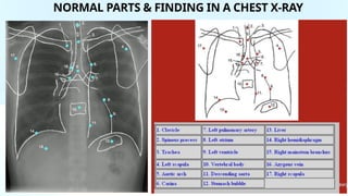 X-Ray BASICS ABDOMEN & CHEST OVERALL BASICS.pptx