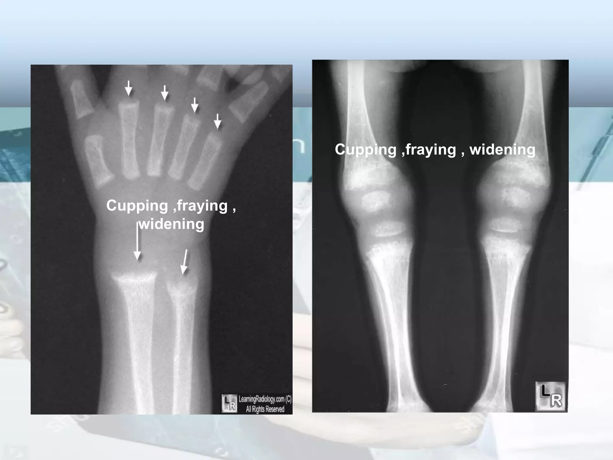 X ray bone disease data interpretation | PDF