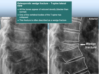 X ray bone disease data interpretation | PDF