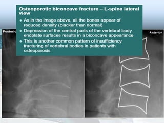 Biconcave Appearance