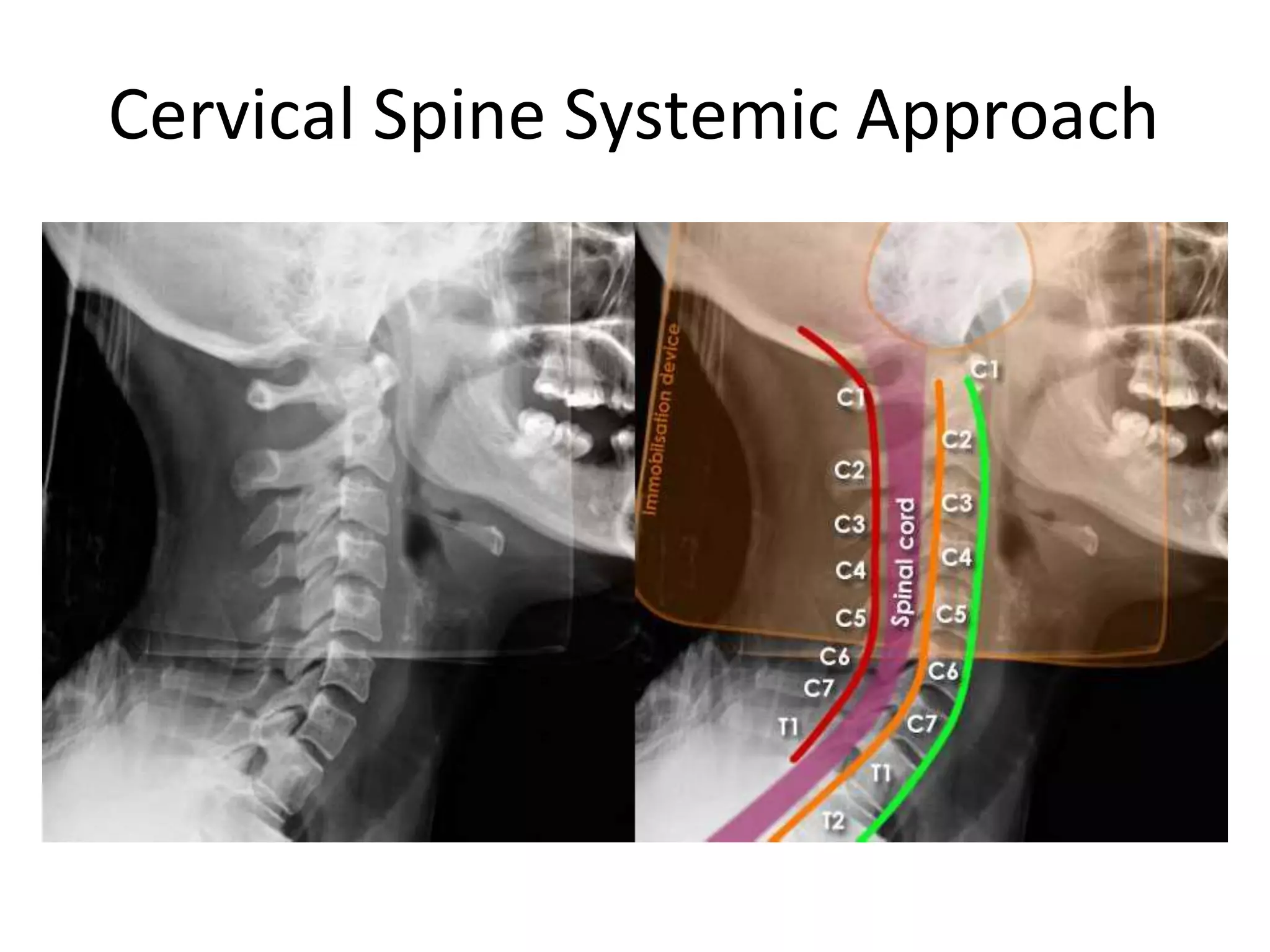 X ray c-spine | PPTX