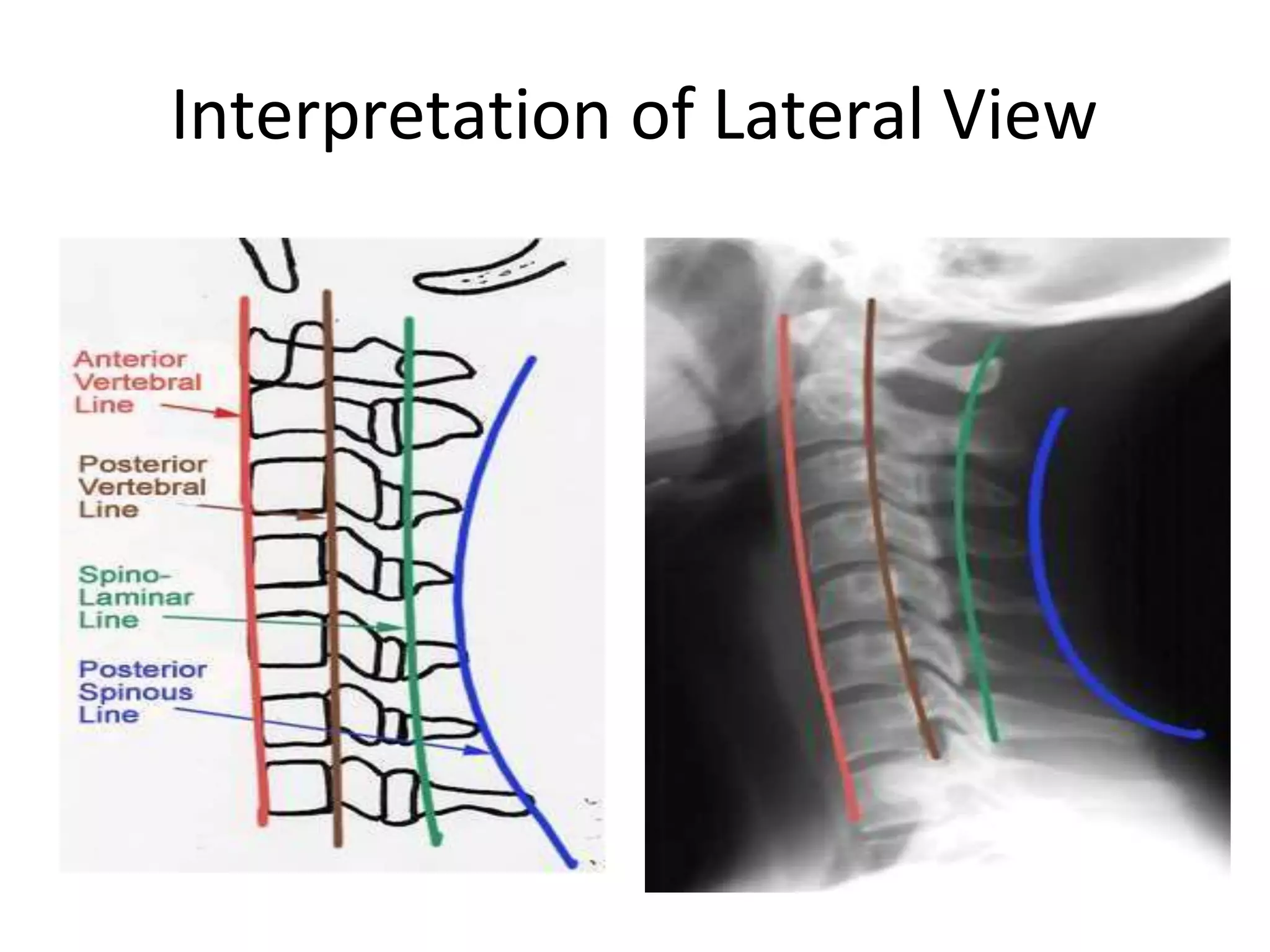 X ray c-spine | PPTX