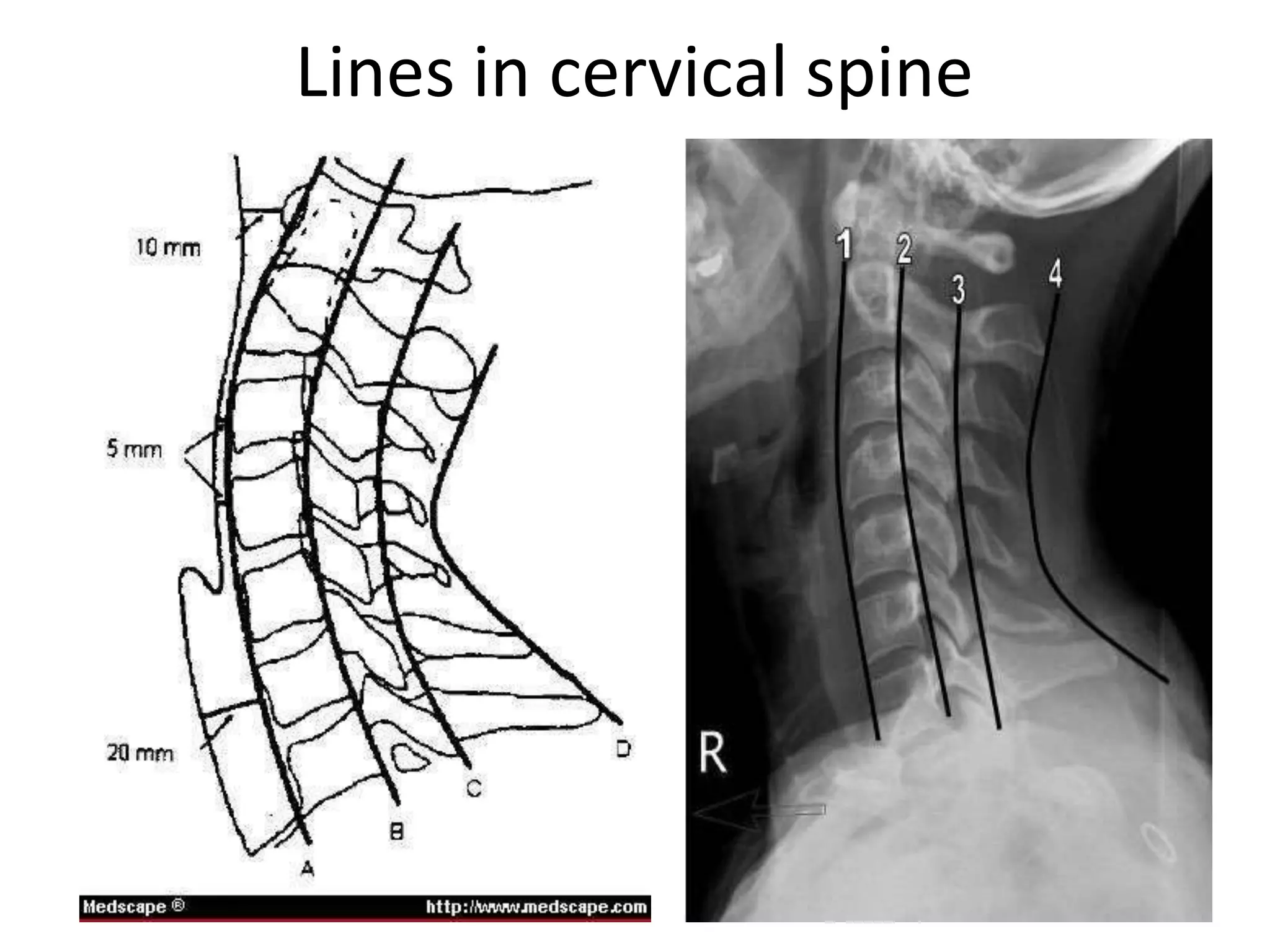 X ray c-spine | PPTX