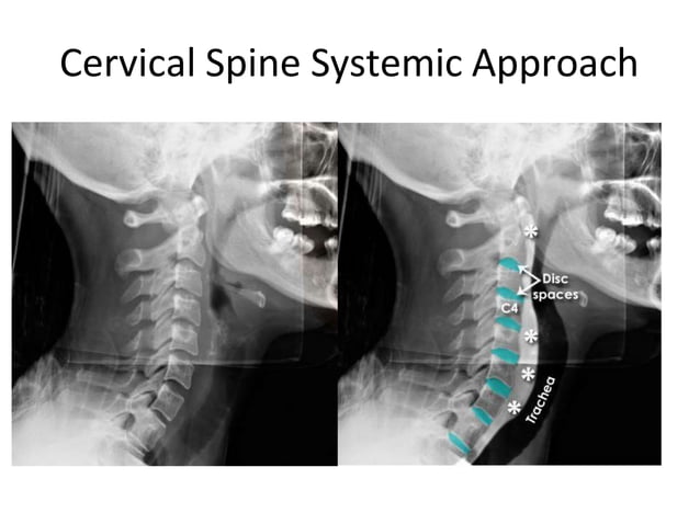 X ray c-spine | PPTX
