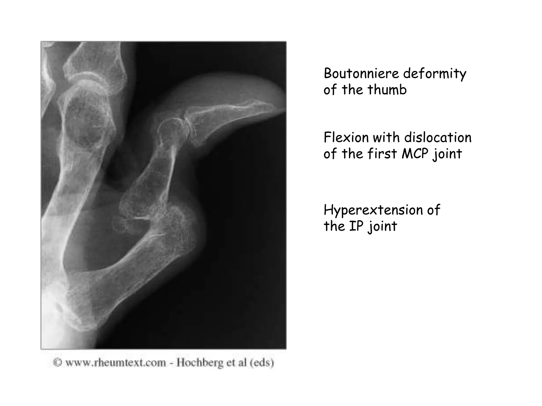 X ray changes in different types of arthritis | PPTX