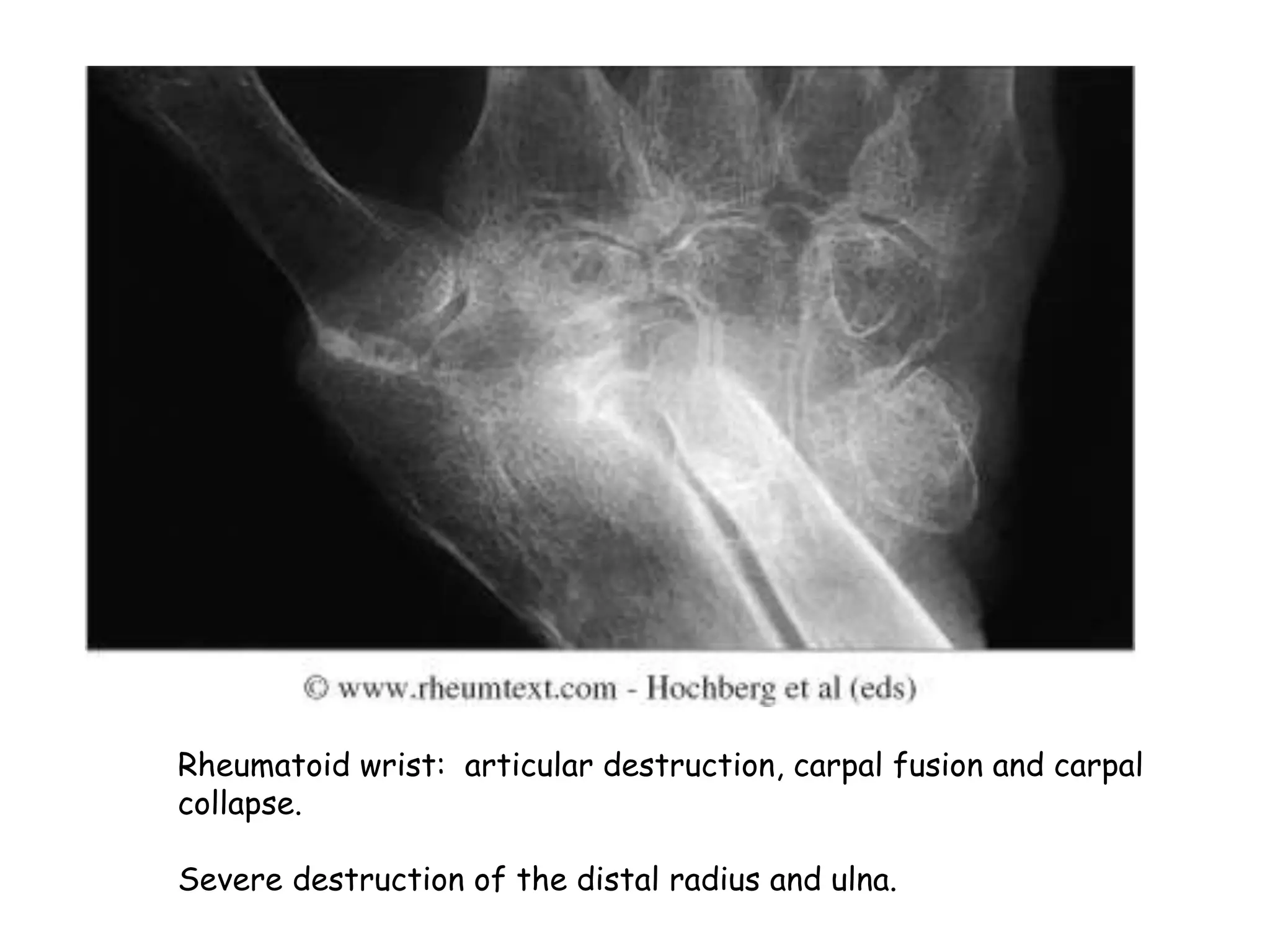 X ray changes in different types of arthritis | PPTX