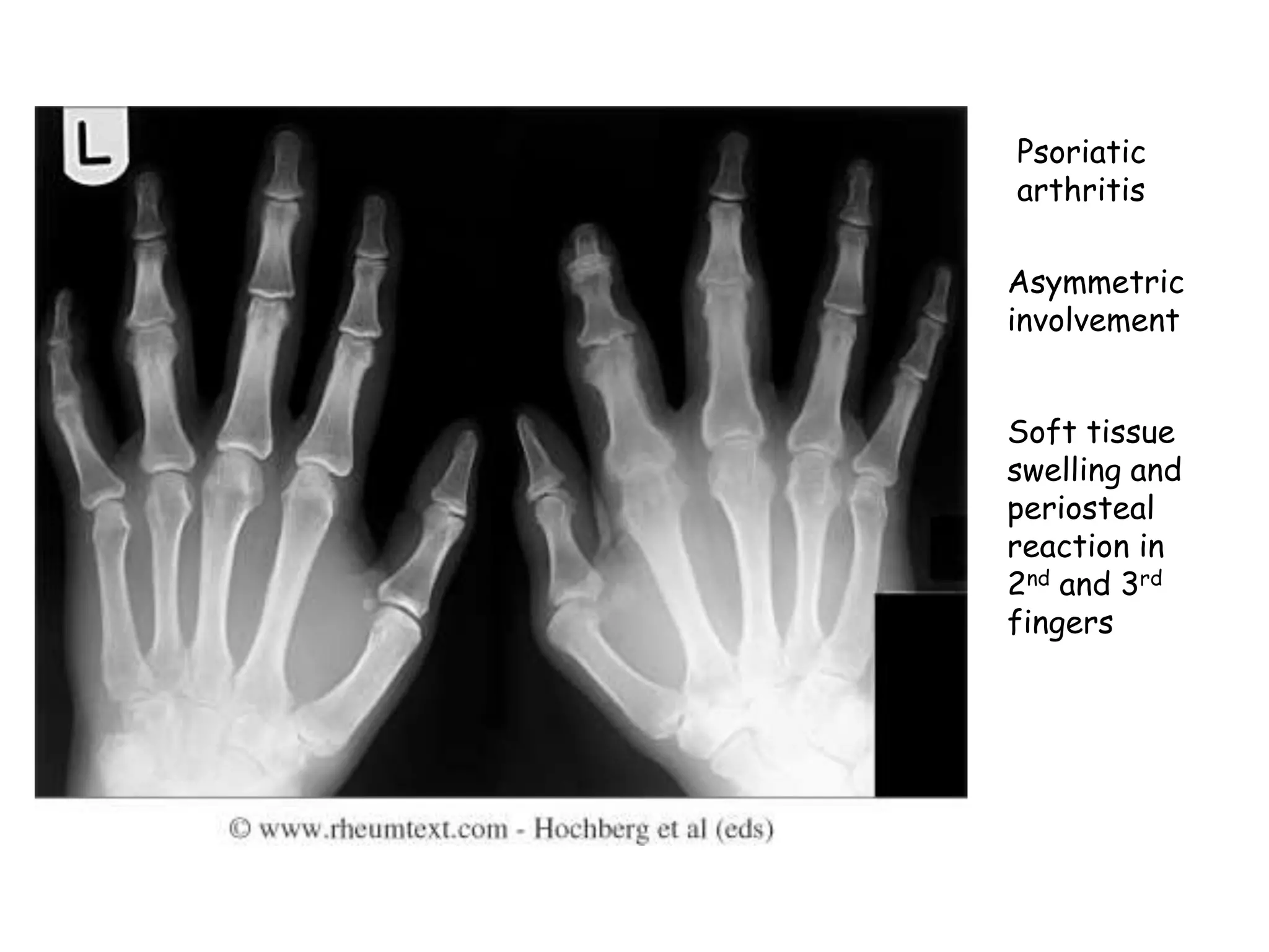 X ray changes in different types of arthritis | PPTX