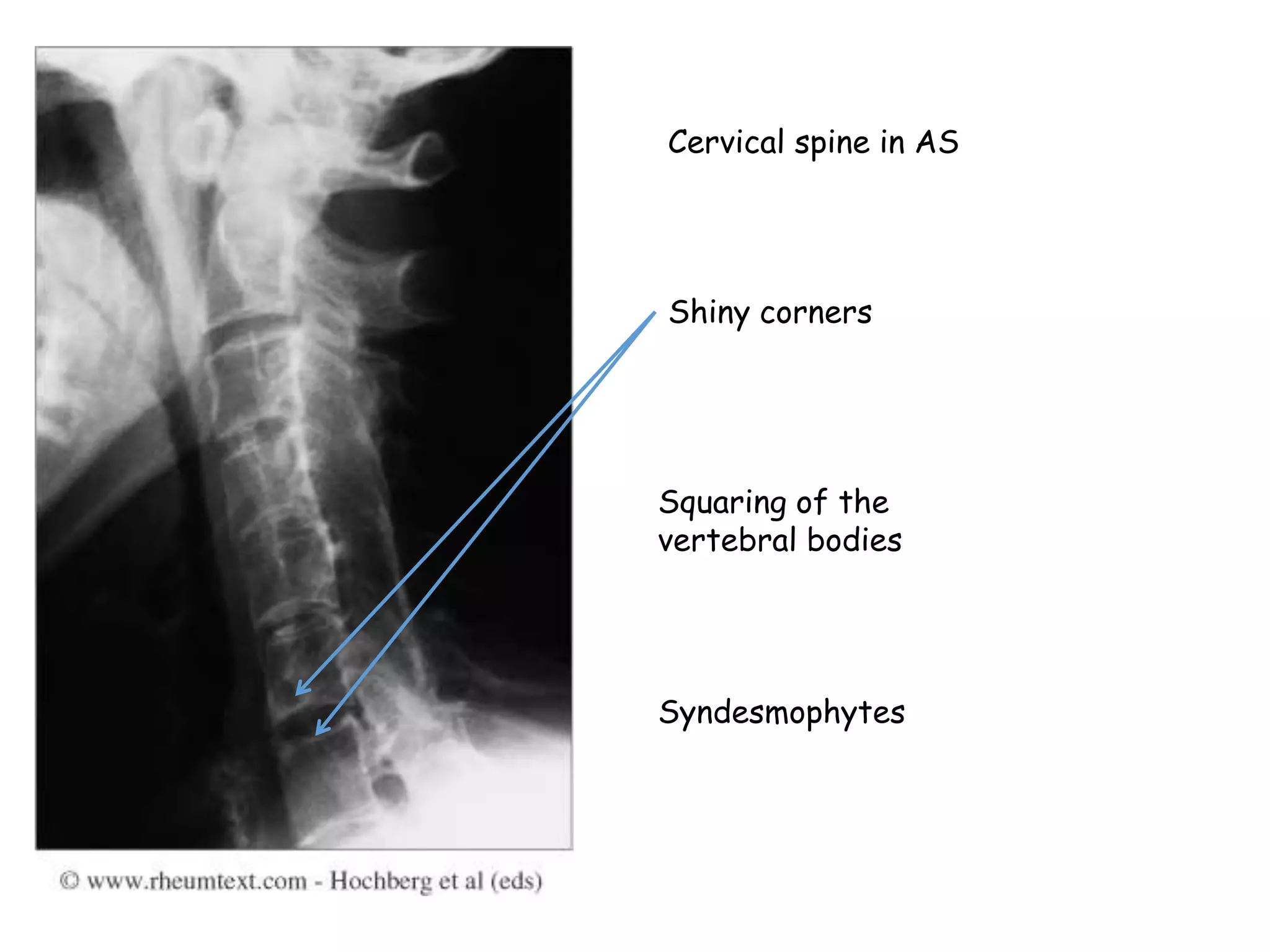 X ray changes in different types of arthritis | PPTX