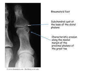 Rheumatoid Arthritis X Ray