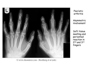 Psoriatic Arthritis X Ray