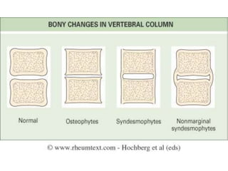 Non Marginal Syndesmophytes
