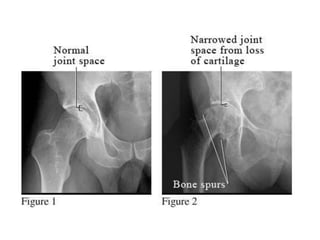 Rheumatoid Arthritis Vs Osteoarthritis X Ray