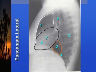 X-RAY DADA - (SISTEM RESPIRASI) | PPT